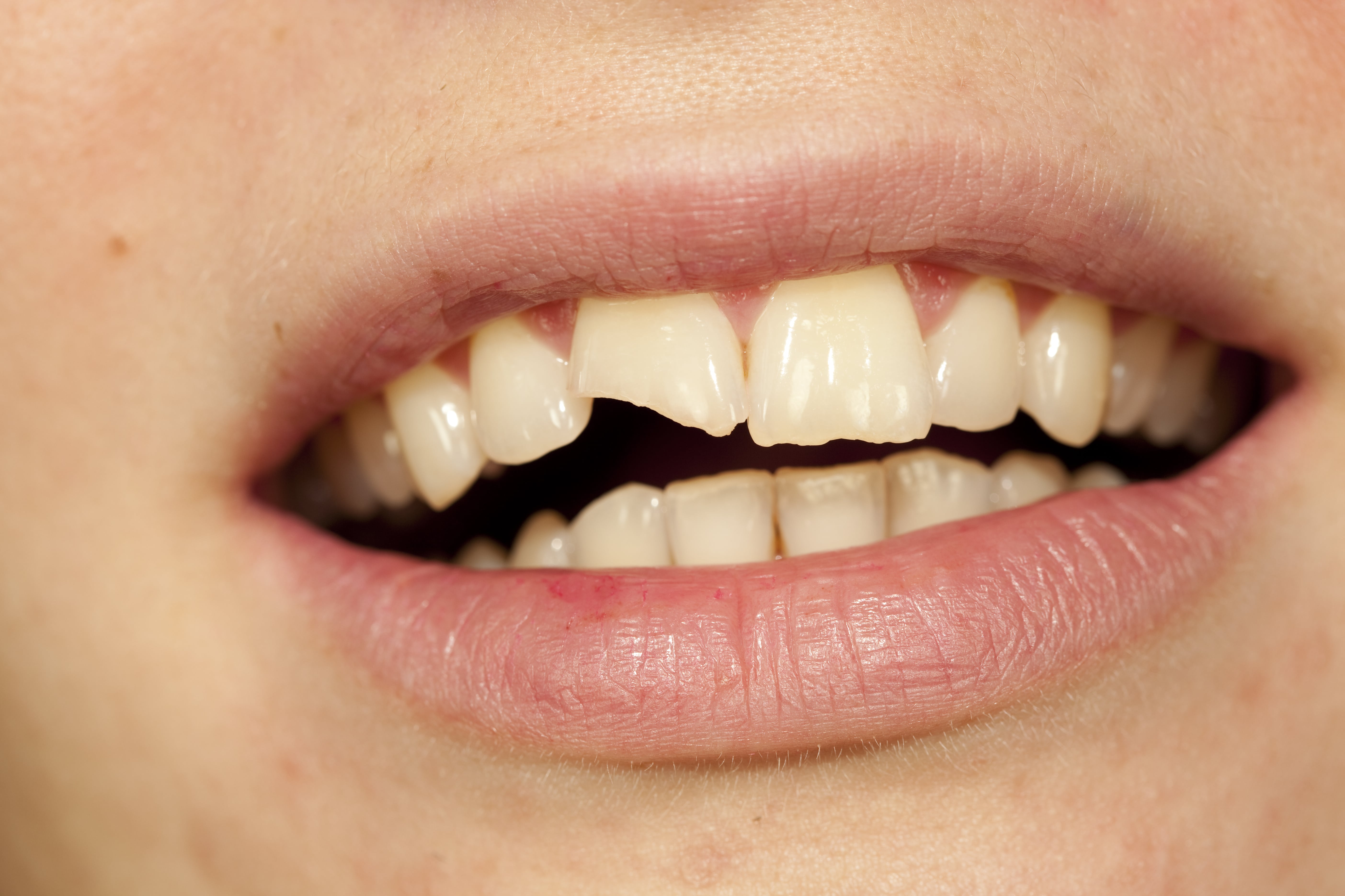 Cracked Or Chipped Front Tooth What Can You Do Cracked Or Chipped Front Tooth What Can You Do