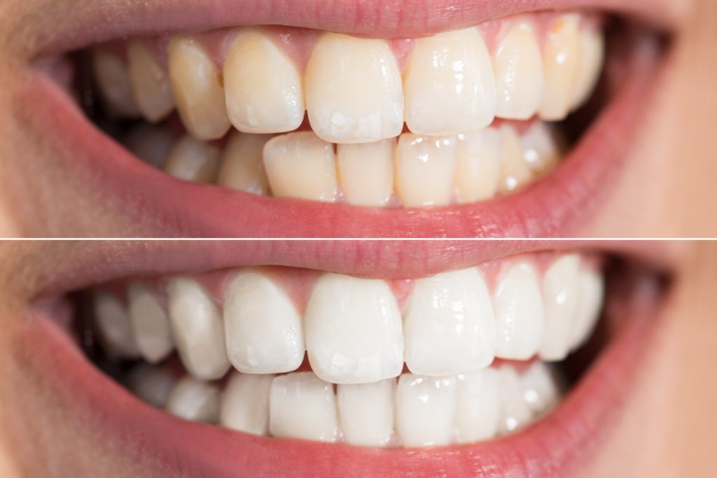 Professional Teeth Whitening Offers Immediate And Better Results.