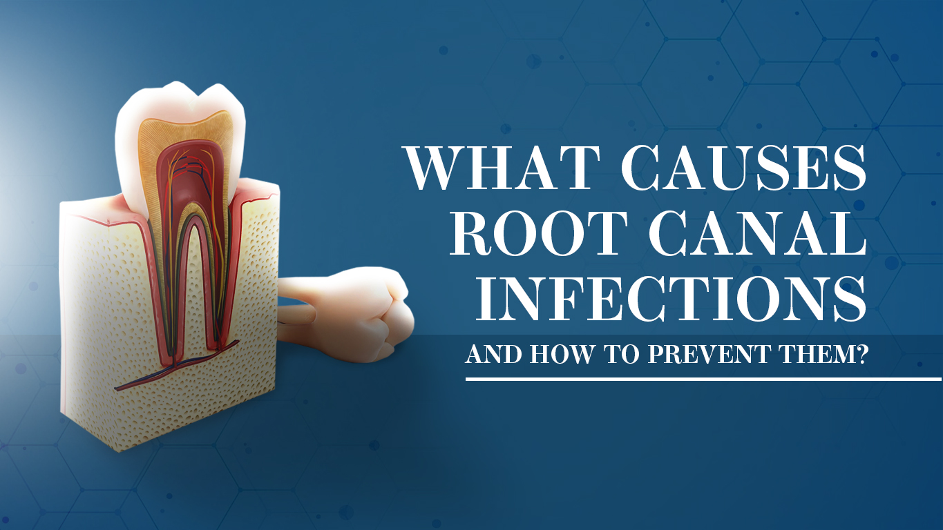 Root Canal Infection