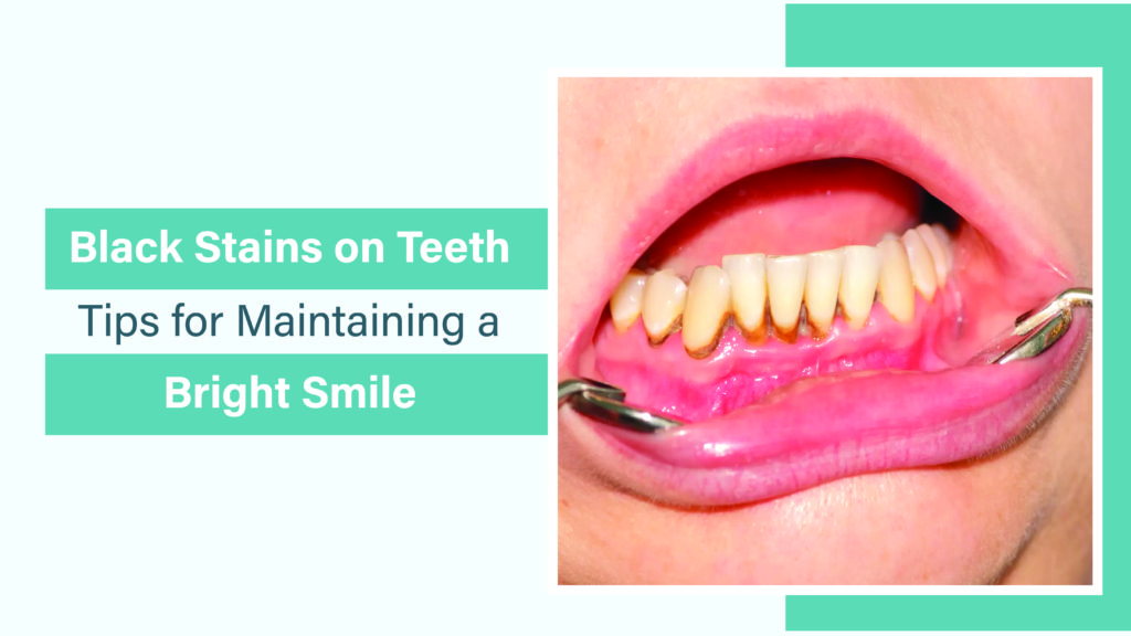 Brighten Your Smile: How to Deal with Black Stains on Teeth