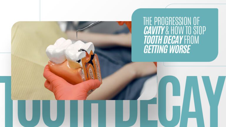 Cavity Progression & How to Stop Tooth Decay - Prevention Tips
