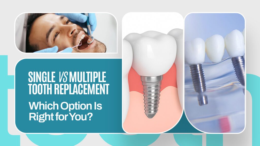 Know About Missing Tooth Replacement Options